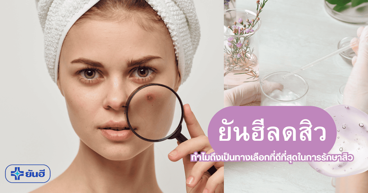 ยันฮีลดสิว ทำไมถึงเป็นทางเลือกที่ดีที่สุดในการรักษาสิว | Yanhee ...